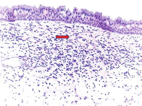 Weak Staining 1 With Nt 3 In The Interstitial Matrix Arrow Of The