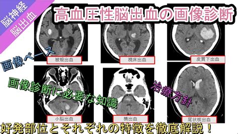 高血圧性脳出血の画像診断 Youtube