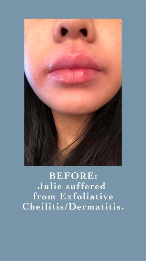 Amperna Do You Have Perioral Dermatitis Angular