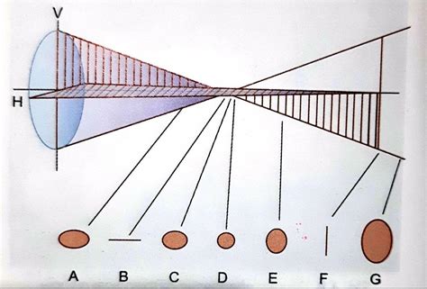 Astigmatism Medical Junction