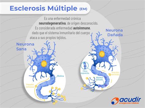 Esclerosis Múltiple Acudir Emergencias Médicas