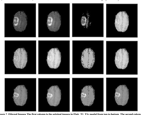 Figure 1 From Brain Tumor Segmentation Using Concurrent Fully Convolutional Networks And