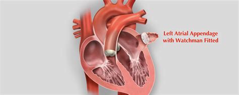 Watchman Procedure