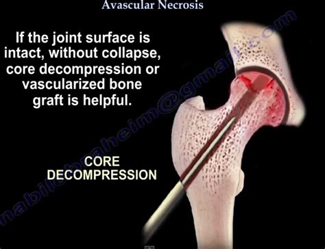 Avascular Necrosis Of Femoral Head —