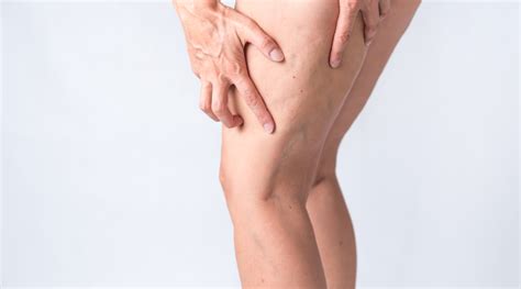 Ceap Classification Of Chronic Venous Disorders