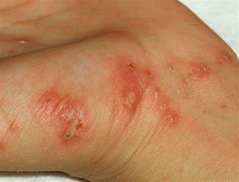 👉 Scabies Rash Pictures Symptoms Treatment Causes February 2022