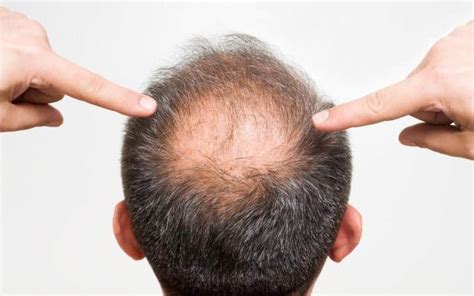 Uncovering The Mystery Of Balding Genetics