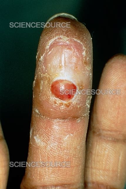 Pyogenic Granuloma Affecting The Finge Stock Image Science Source Images