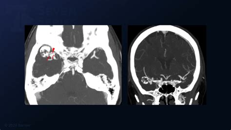 299 Trapping And Excision Of A Calcified Mca Aneurysm With An Anterior Temporal Artery Donor 299 Trapping And Excision Of A Calcified Mca Aneurysm With An Anterior Temporal Artery Donor