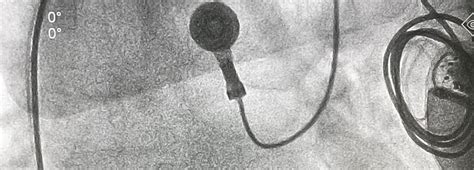 Replacing A Pacemaker Should You Be Worried