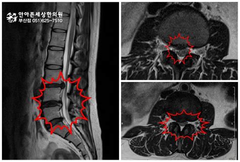허리 디스크의 위치에 따른 통증의 분포에 대해 네이버 블로그