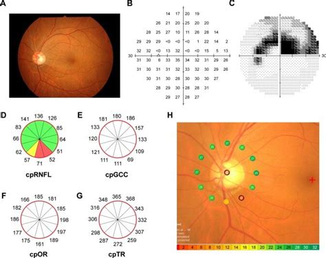 Glaucoma Visual Field