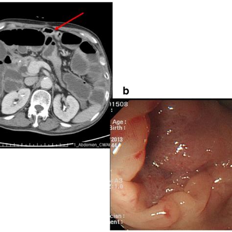 Pdf Two Rare Cases Of Synchronous And Metachronous Colonic Metastases In Patients With