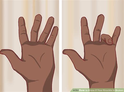 Doctor Approved Advice On How To Know If Your Knuckle Is Broken