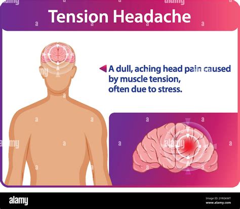 Illustration Of Tension Headache Symptoms And Causes Stock Vector Image
