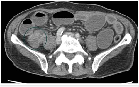 Diffusely Dilated Ileal Loops With Thickened And Deformed Terminal