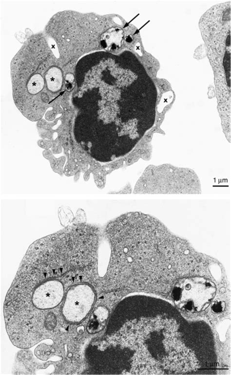 Myelodysplastic Syndrome Mds Erythroblast Showing Morphological