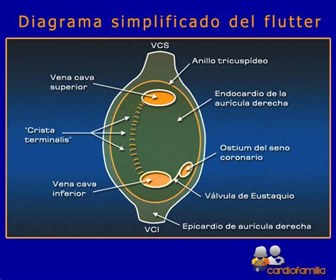 Etiología Clínica Y Tratamiento Del Flutter Auricular Etiología Clínica Y Tratamiento Del Flutter Auricular
