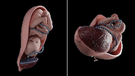 Placenta Previa Classification Causes Symptoms Treatment