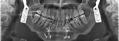 Tmj Implants The Tmj Association