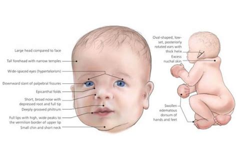 Cri Du Chat Syndrome Cdcs 115000 To 150000 Births Per Year