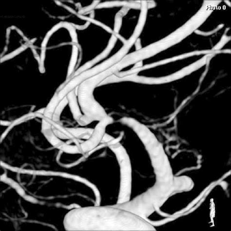 Pretreatment 3dra Image Of 96 Stenosis At The Distal M1 Segment Of The Download Scientific