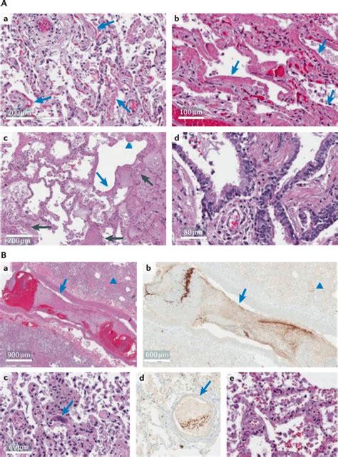 Endothelial Dysfunction And Immunothrombosis As Key Pathogenic