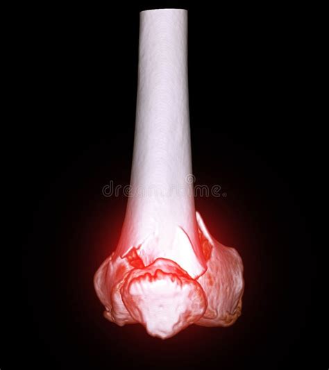 Ct Scan Of Knee Joint 3d Rendering Image Showing Fracture Of Distal