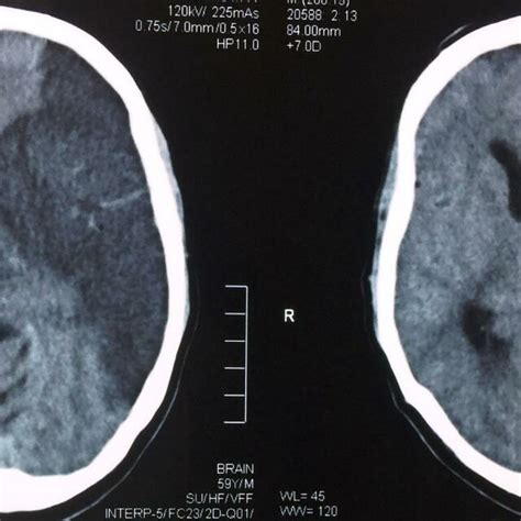 Ct Scan Brain Showing Massive Left Frontal Parietal And Occipital