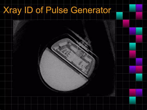 Pacemaker Radiologyanintroduction Ppt