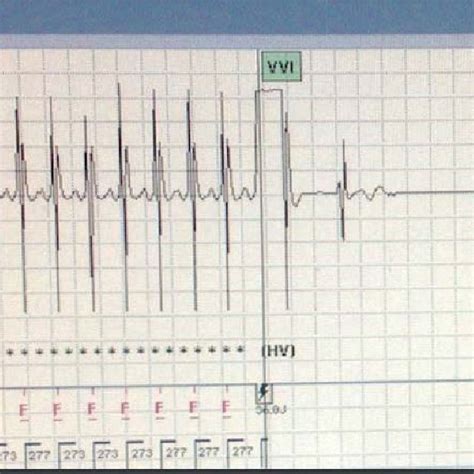 Icd Interrogation Intracardiac Electrogram Showing Vf Detection And