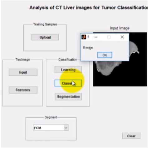 Liver Tumor Detection Using Matlab