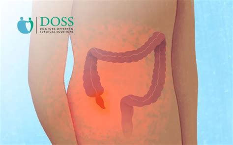 What Does The Appendix Do Its Role In Gut Health And Immunity