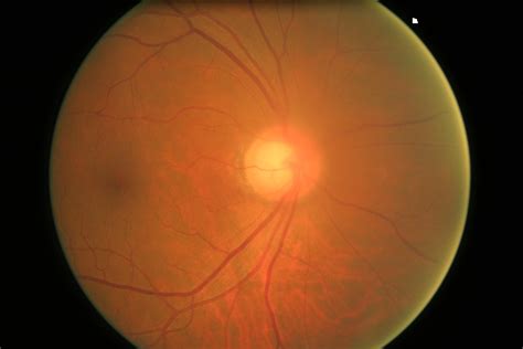 Optic Disk Detection Object Detection Model By Glaucoma