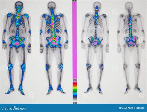 Spine Metastasis Cancer Spread To Thoracic Spine Mri Of Thoracic And Lumbar Spine Show
