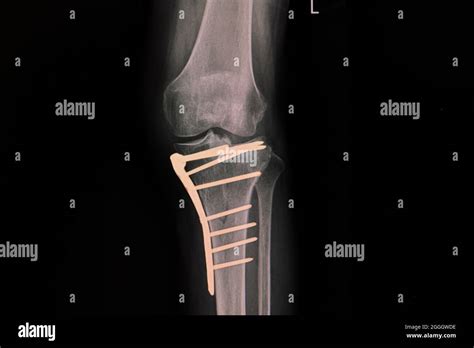 Fractured Tibia