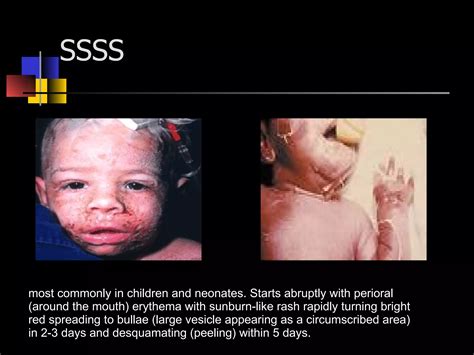 Staphylococcus 2 Ppt