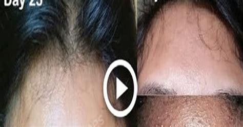 How To Get Rid Of Pimples On Forehead Naturalcreambeauty