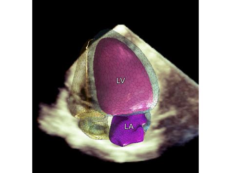 Philips Epiq Cvx Ice