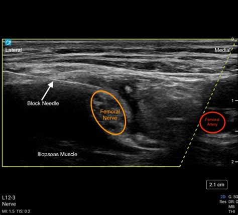 How To Perform A Femoral Block Fujifilm Sonosite