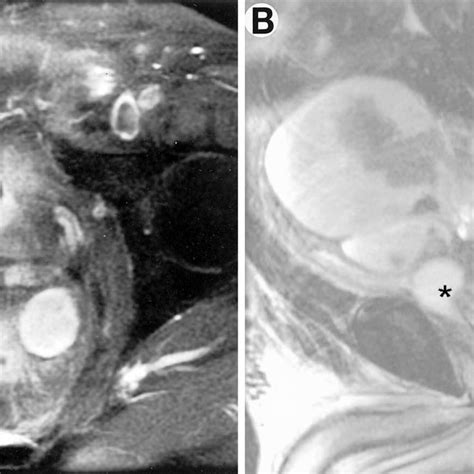 Axial T1 A And Sagittal T2 B Weighted Mris Demonstrate Large