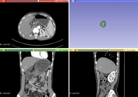 Ct Radiomics Nomogram Shows Promise In Predicting Early Recurrence Of Hepatocellular Carcinoma