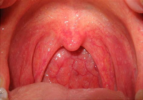 Sensitive To Cold Water Sore Throat Sore Throat Is A Sign Of