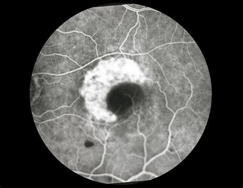 Armd With Rpe Rip Retina Image Bank