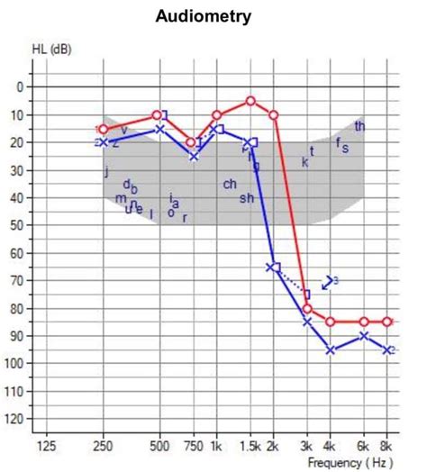 What Has For This Steep High Frequency Loss Rhearingaids