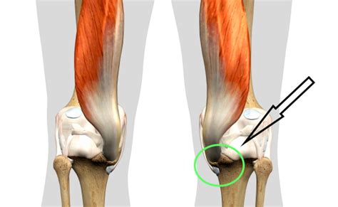 All You Need To Know About Low Hamstring Tendonitis Sport Doctor London