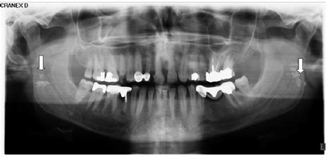 Tonsilloliths Radiograph