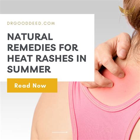 Heat Rash Artofit