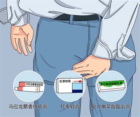 真正能消肉球的痔疮膏 有来医生
