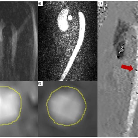 A Magnitude Image Of The 4d Flow Sequence With Grappa Showing Download Scientific Diagram